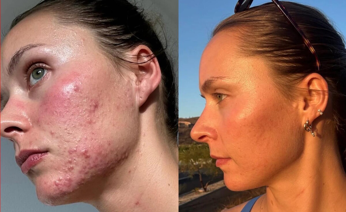 PuraU: Solve Your Acne by Tackling The Root Cause | Supreme Living